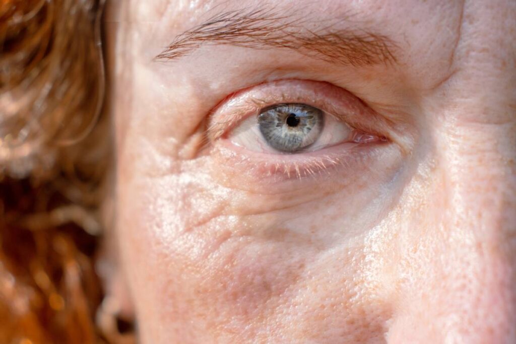 How To Tighten Eyelid Skin Without Surgery? | Sarah Avila MD