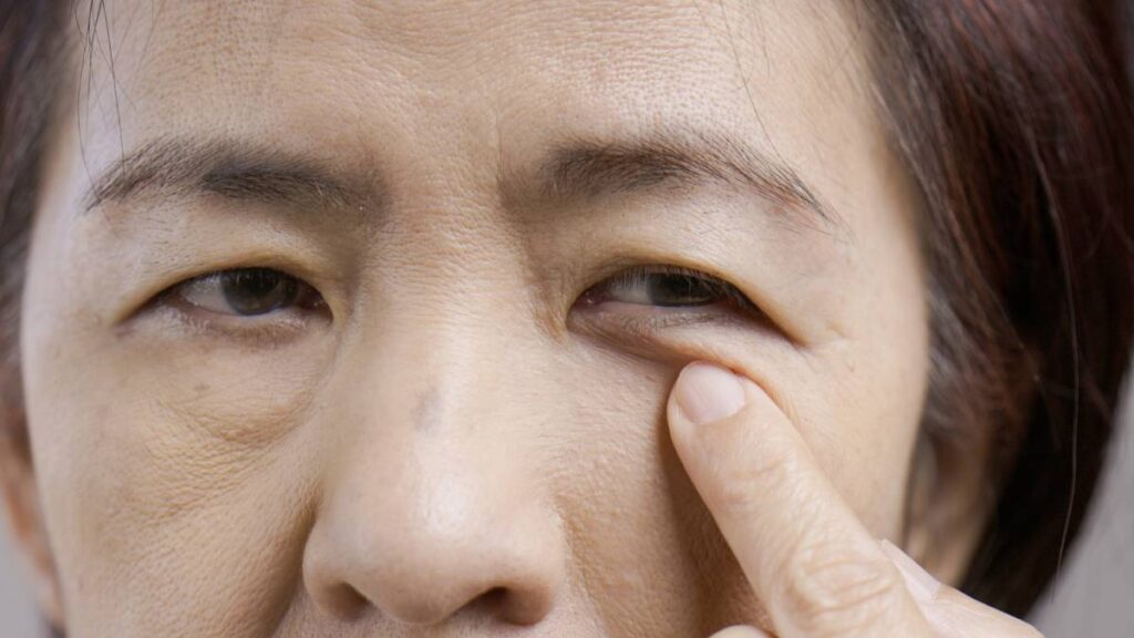 Eyelid Surgery and Aging: What to Expect as Time Passes | Sarah Avila MD